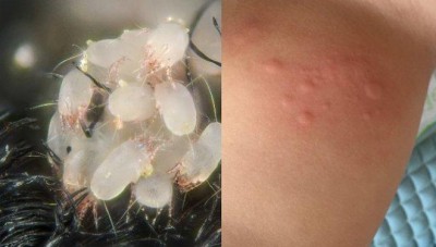 Gatal Karena Tungau? Ini Cara Mencegahnya - TIMES Indonesia