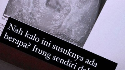 5 Fakta Dibalik Viral Foto X-Ray Diduga Penampakan Ratusan Susuk ...
