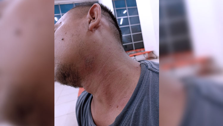 Membuat Tak Nyaman, Pasien Isolasi Terpadu Diganggu Serangga Tomcat ...